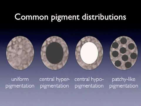 Iris Zalaudek on reticular pattern benign naevi | Dermoscopy