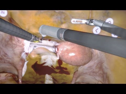 Robotics expansion at Penn State Health St. Joseph – Jamie Gretzky, Physician Assistant