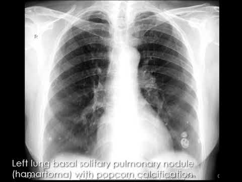 CASE 938 pulmonary hamartoma