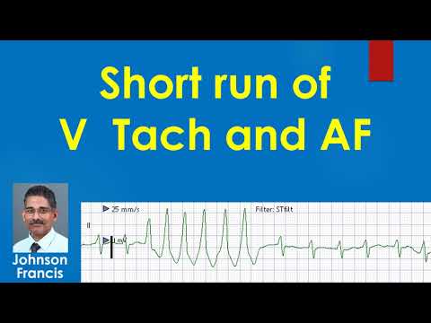 Short run of Ventricular Tachycardia and Atrial Fibrillation