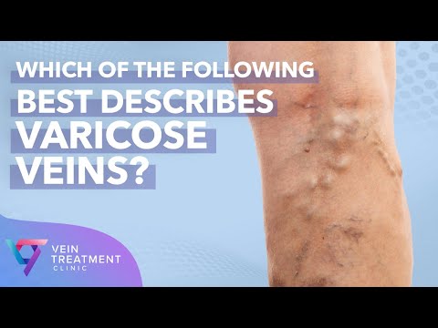 Medical Center: Which of the following best describes varicose veins | Vein Treatment Center
