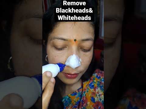 remove blackheads and whiteheads using Fevicol #viral#tumtum#blackheads#whiteheads#blackheadsremover