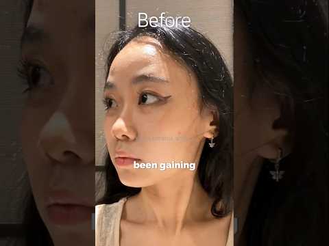 Engene got surgery to look like Jungwon #enhypen #shorts #shortsfeed #shortsviral #kpopnews