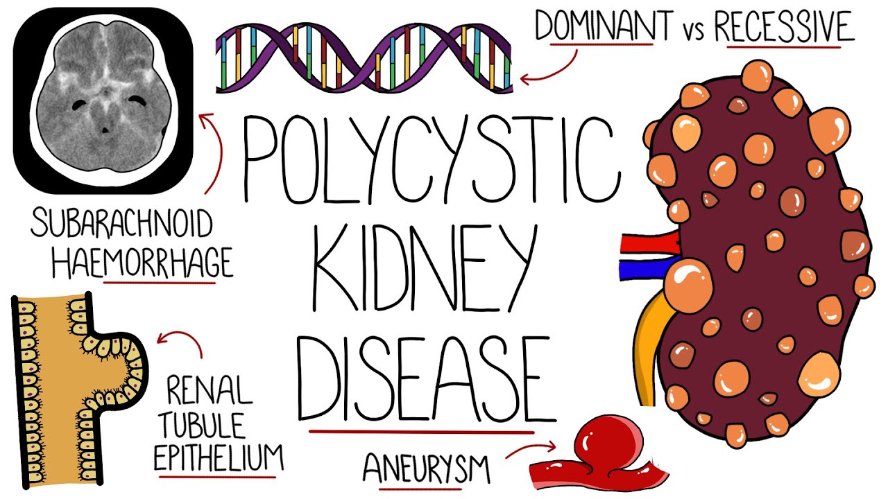 Polycystic Kidney Disease Explained