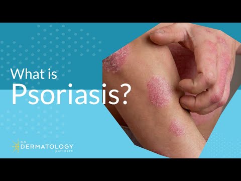 What Is Psoriasis?