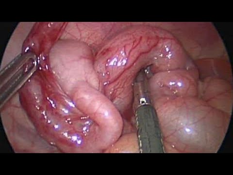 Appendix in hindi || appendix pain symptoms right side