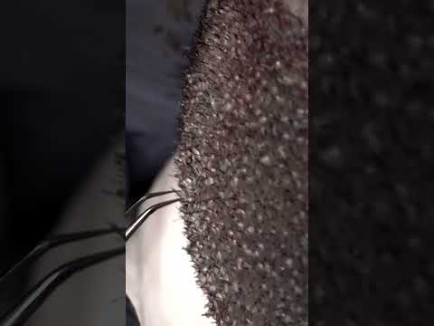 Your hair transplant have to be with us!