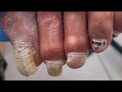 The Old Witch's Nails! Long And Hard Onychomycosis, Very Laborious To Trim【Pedicure Master Lin Jun】