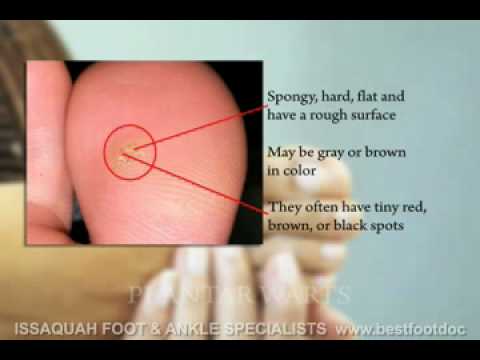 Plantar Warts Care - Issaquah Foot and Ankle Specialists