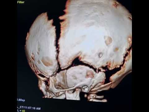3D of lobar holoprosencephaly case