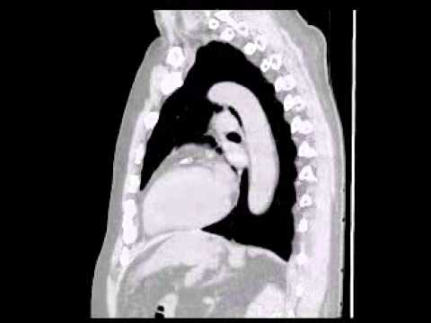 Lytic lesions in multiple myeloma (lower res)