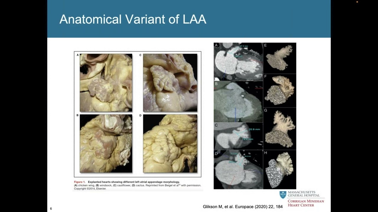 Left Atrial Appendage Occlusion Device  Indications and Management in Atrial Fibrillation