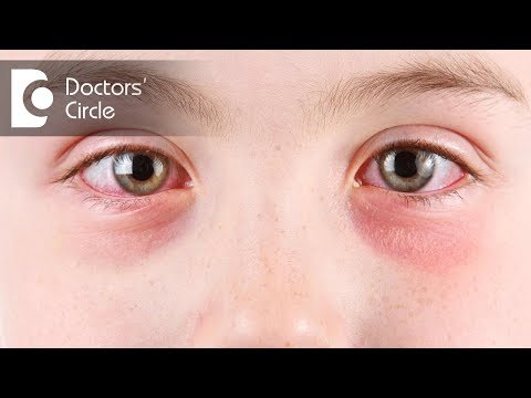 Symptoms of eye allergies - Dr. Sriram Ramalingam