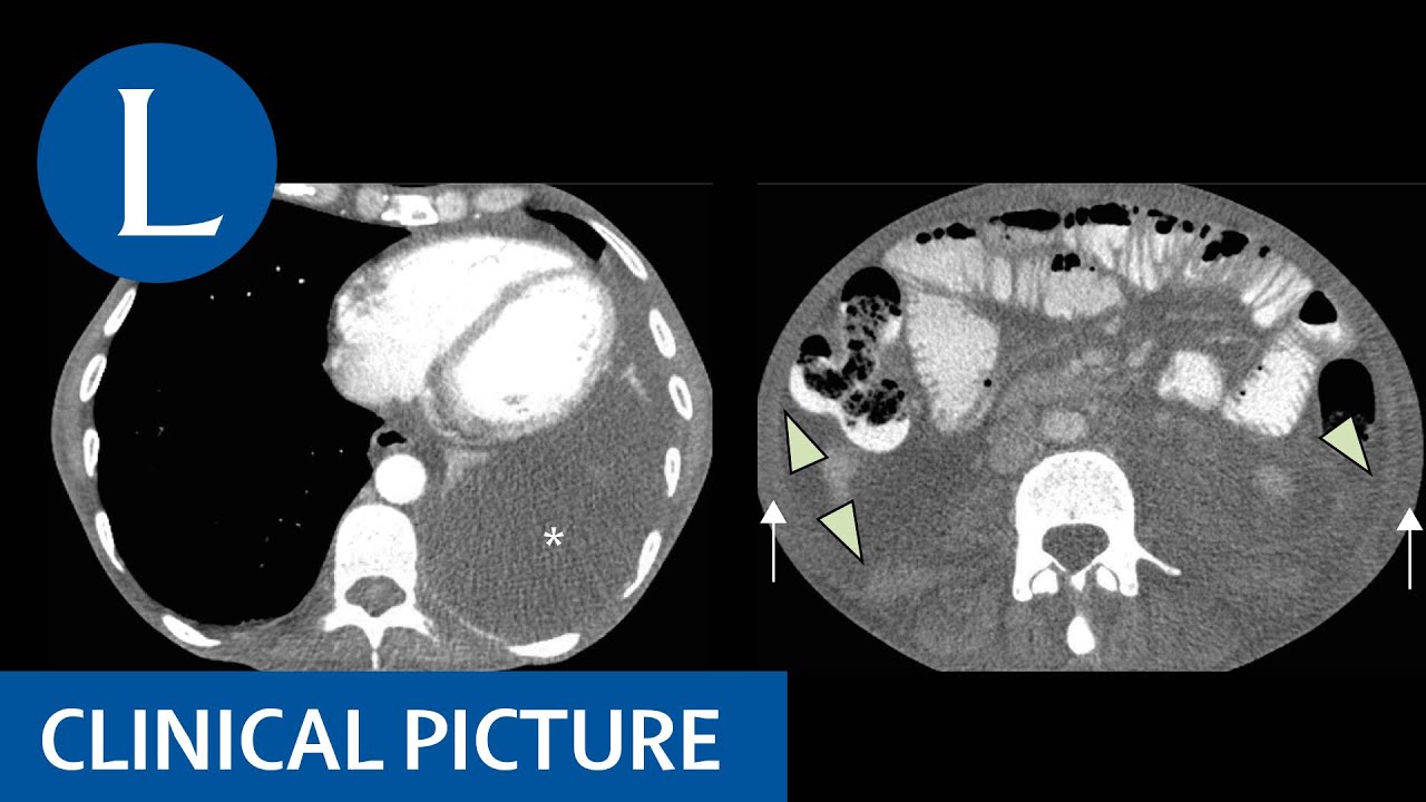 Muckle Wells syndrome