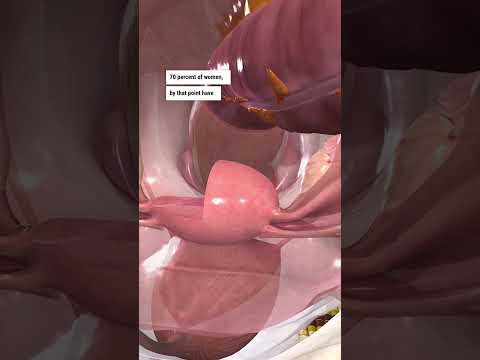 Uterine Fibroids: Understanding Leiomyomas #fibroids