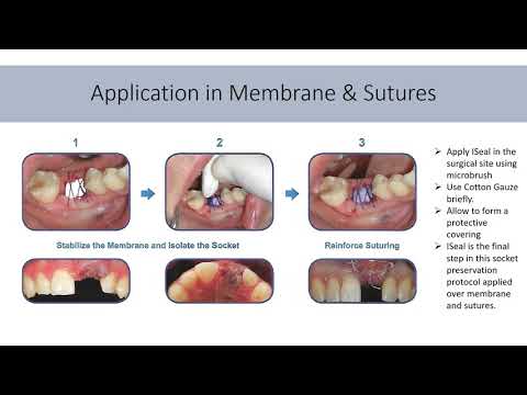 Medical Adhesives - Medical Grade Adhesive Latest Price, Manufacturers ...