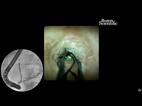 Pancreatoscopy and Successful Retrieval of a Proximally Migrated Pancreatic Stent
