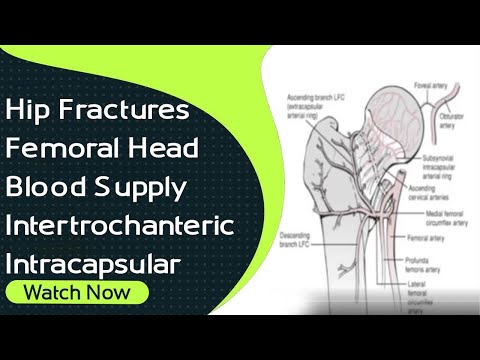 Hip Fractures - Femoral Head Blood Supply | Intertrochanteric | Intracapsular