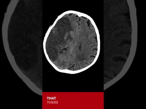 Would you recognize a stroke in this image? #stroke