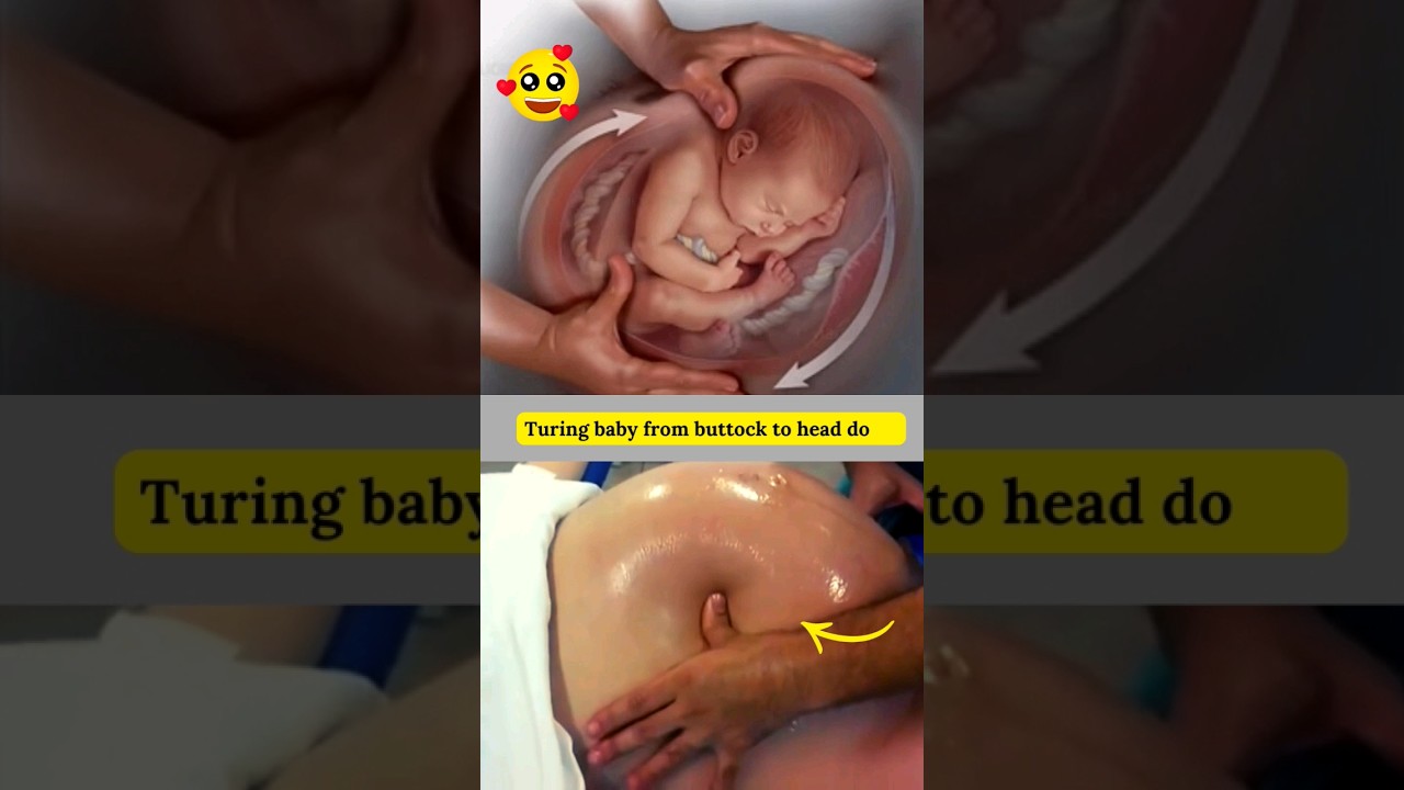 Turning Baby to Head Down Position 🥰 #shortvideo #ecv