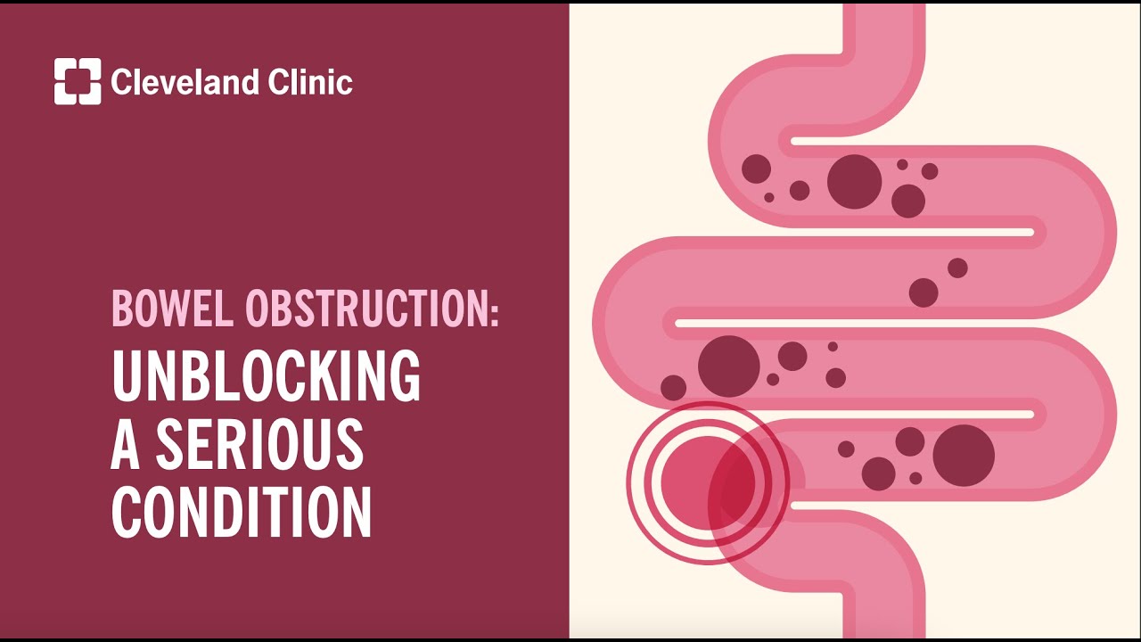 Bowel Obstruction: Unblocking A Serious Condition