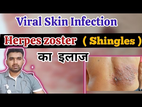 herpes zoster (shingle) treatment in hindi।। हर्पिस जोस्टर (सिंगल्स) का इलाज#herpeszoster #shingles