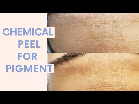 CHEMICAL PEEL FOR HYPERPIGMENTATION: Full procedure, Before and After Photos