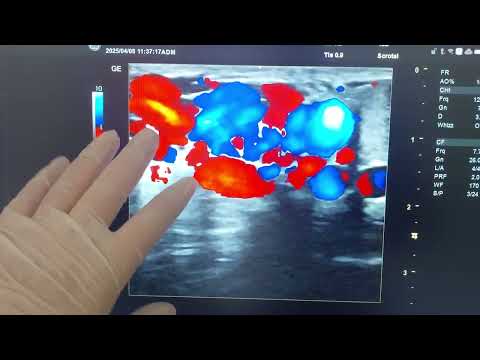 This Recurrent Varicocele Video is for Urology Doctors