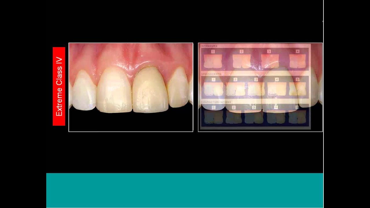 Anterior Composite Webinar & Demonstration
