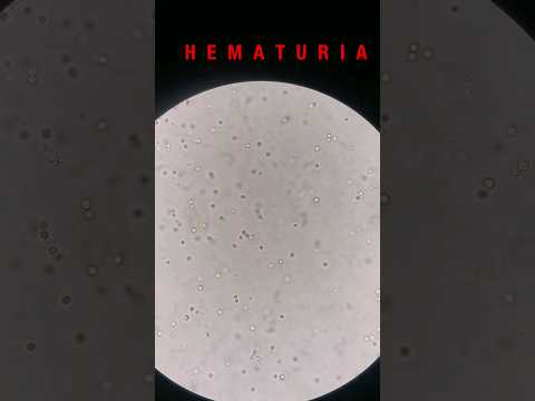 Hematuria blood in urine #microscope #medtechstudent #mls #cls #laboratory #medicaltechnologist #rmt