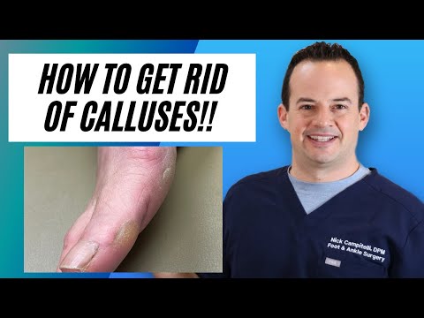 How to remove calluses from your feet | Dr. Nick Campitelli
