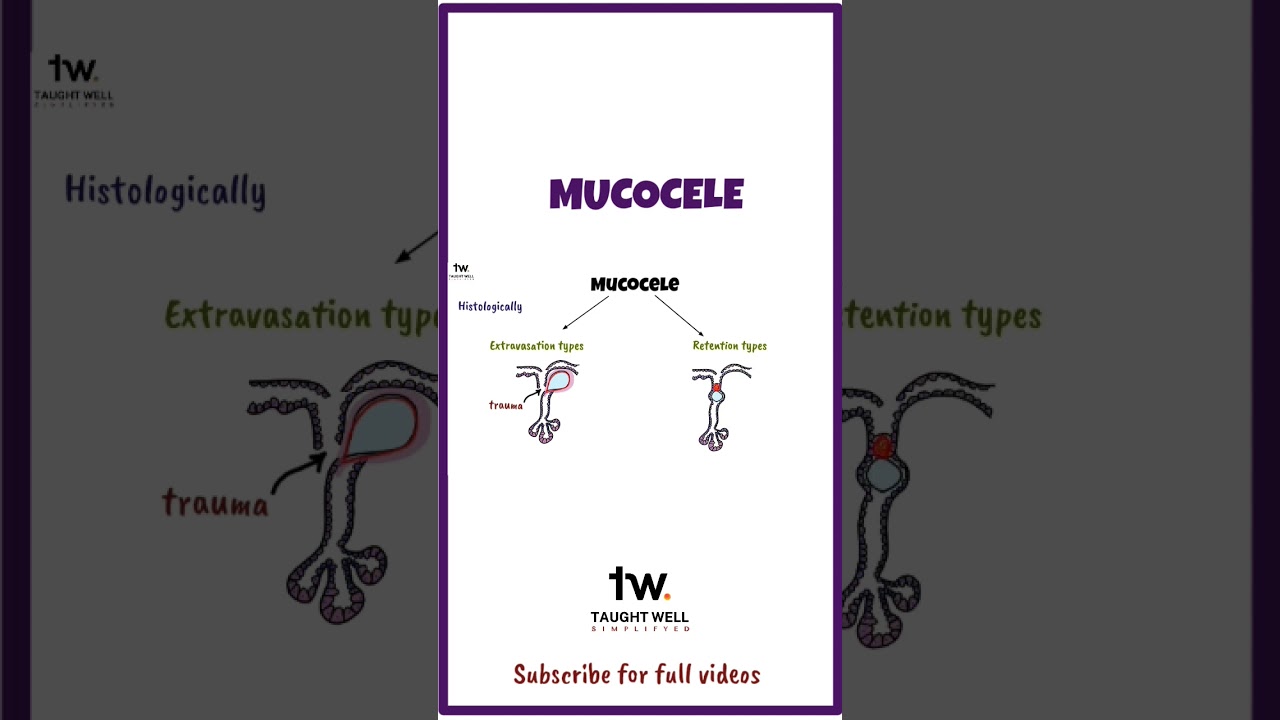 Mucocele | #dentistry #shorts