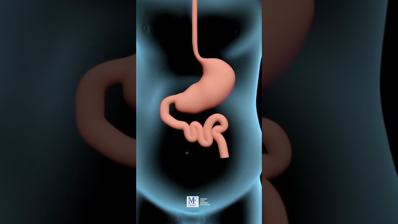 Weight Loss Surgery Causes and Fixes GERD