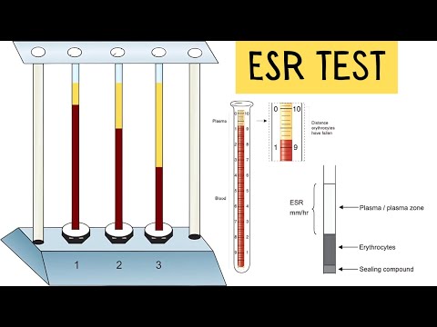 Erythrocyte Sedimentation Rate (ESR) Test What You Need To Know