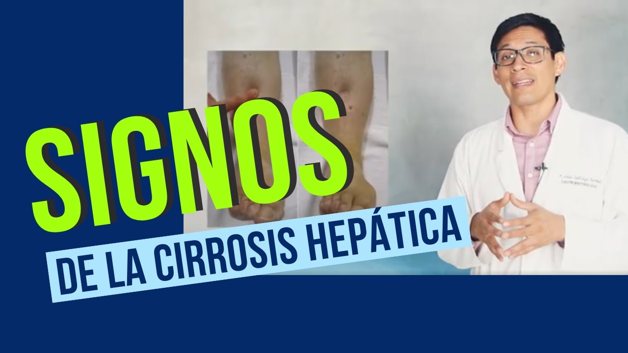 Signos de cirrosis hepática
