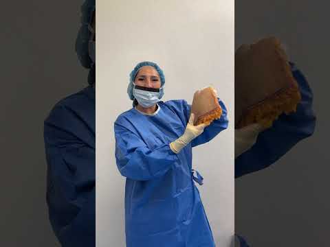 BLOODLESS TUMMY TUCK BY DR GABRIEL PATINO 06 26 2025.(510)525-7999