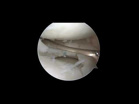 Arthroscopic Saucerization and All-Inside Repair of a Delaminated Discoid Lateral Meniscus