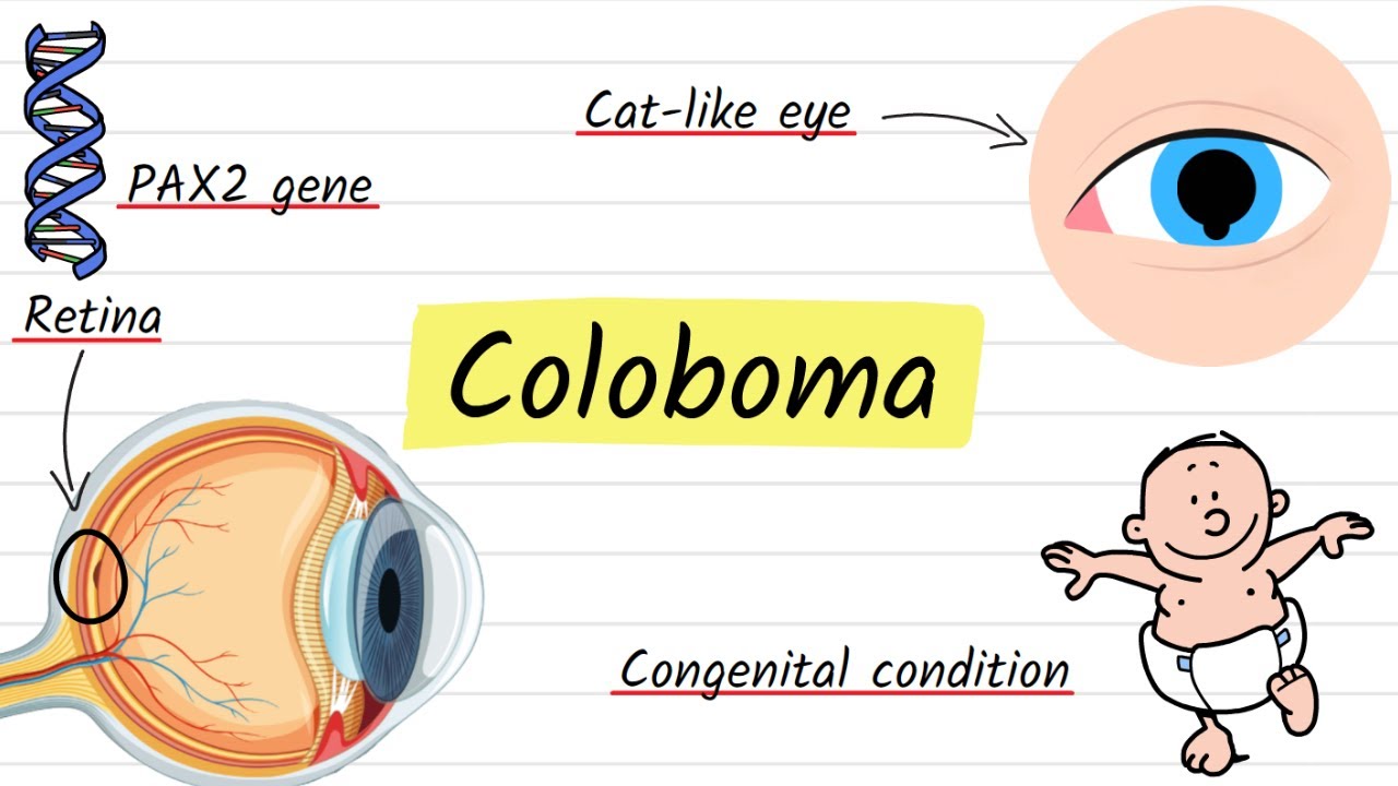Born With a Gap in the Eye? Understanding Coloboma