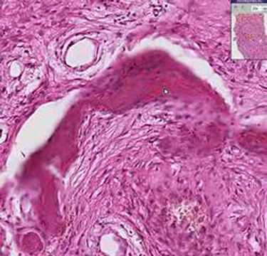 Fibrous Dysplasia - Pathology - Orthobullets
