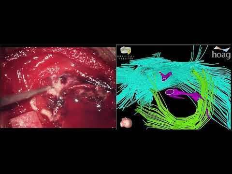 Surgical Theater SyncAR Meningioma Case- Dr. Louis, Hoag