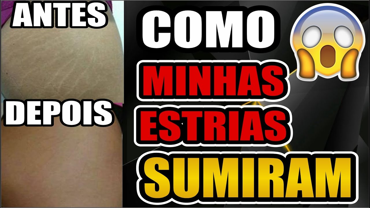 Remedio caseiro para estrias - 5 Receitas Caseiras para estrias