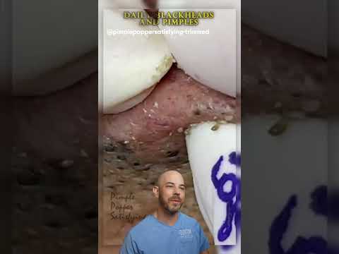 TONS of blackheads get poked out in this video! 📌( credit: @pimplepoppersatisfying on TT) #doctor
