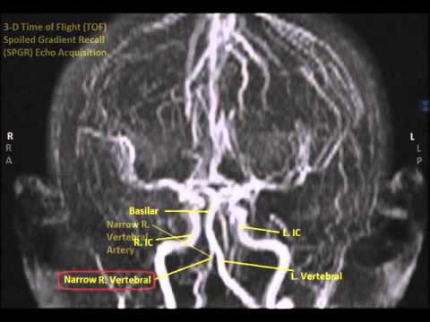 Abnormal Right Vertebral Artery 3-D MRA Sequence-Sanjoy Sanyal