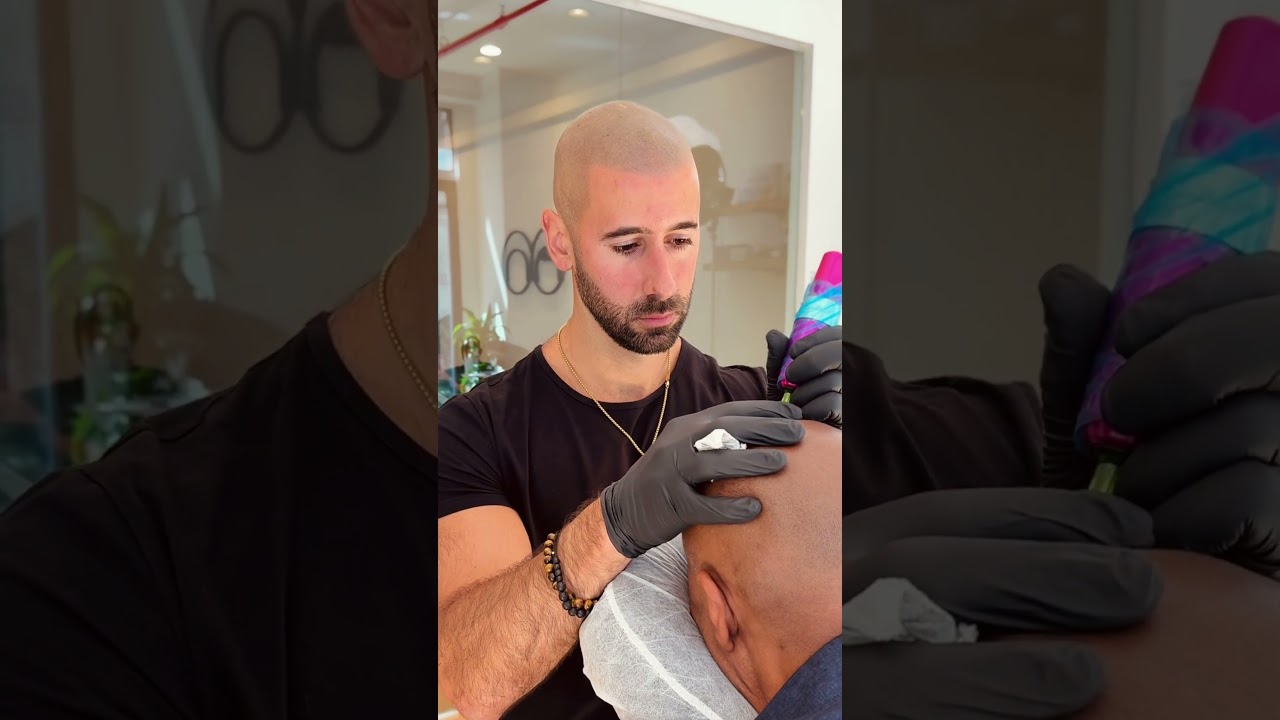 Scalp micropigmentation in action ⚡️ #hairlosstreatment #hairtattoo #scalpmicropigmentation