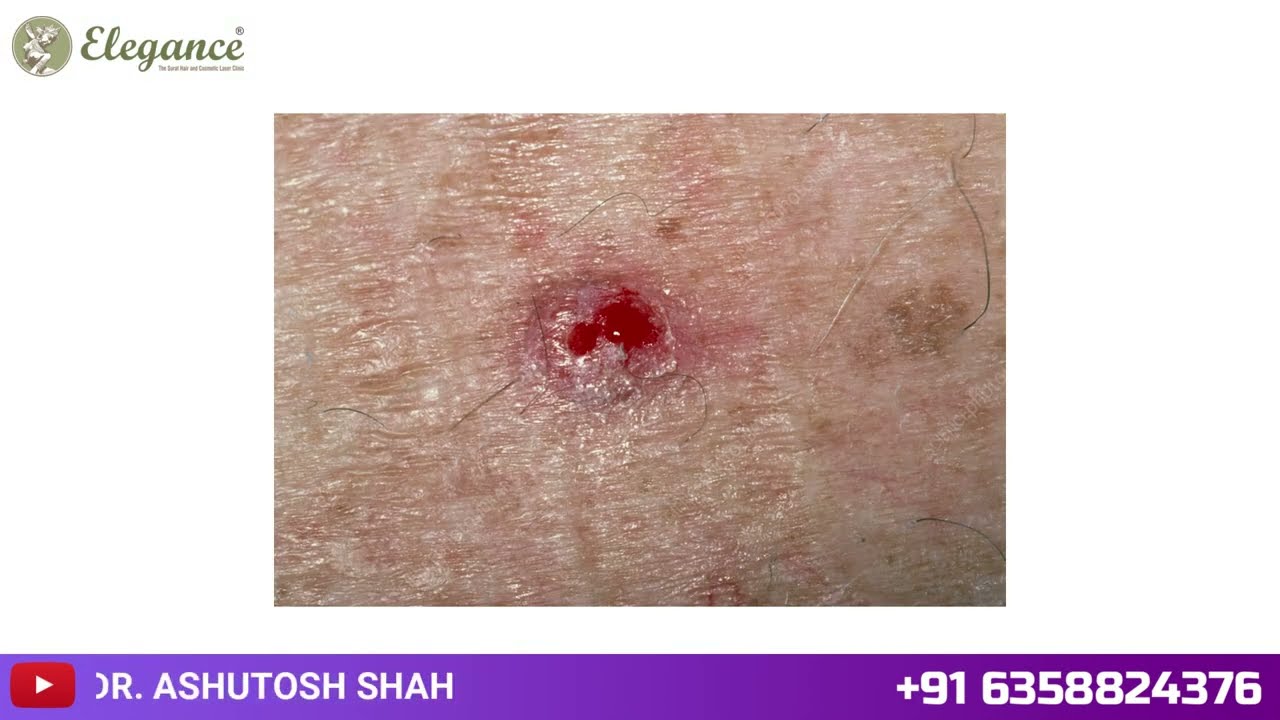 Basal cell carcinoma, Skin Cancer, Treatment, Skin Cancer Treatment, Surat, Navsari, Bharuch