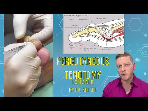 Percutaneous Tenotomy Explained - By Dr. Roger Kilfoil! ASMR Bonus at the end!