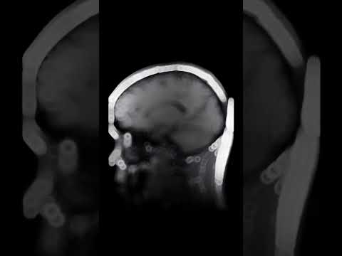 MRI MAGNETIC RESONANCE IMAGING IN SPANISH | Medical Consecutive Interpreting
