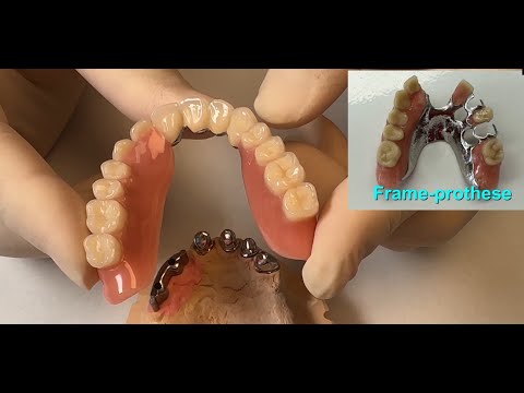 Frame-prothese, telescoop-prthese, frictie steg, gehemelte vrije prothese