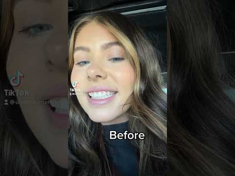 How Crown Lengthening Can SAVE Your Smile! 😁🦷