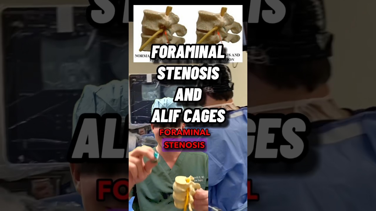 Treatment for Foraminal Stenosis (one of many!) 👨‍⚕️🇺🇸